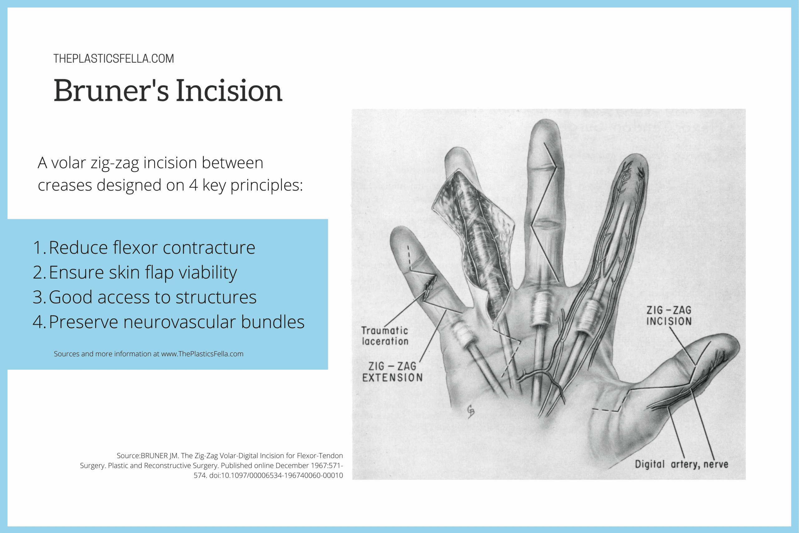 Volar Incisions – Bruner, Mid-lateral & others