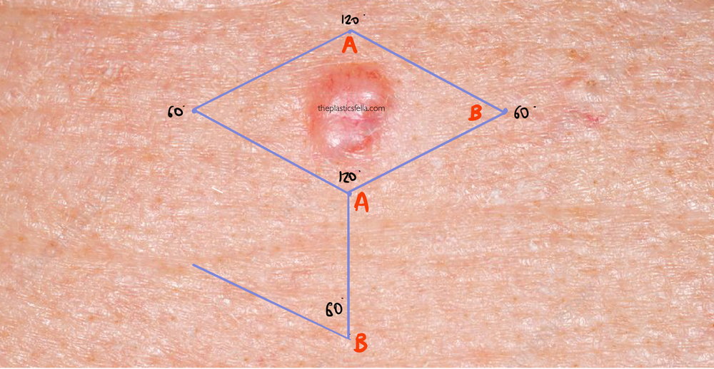 Rhomboid Flap - Indications, Design, Examples
