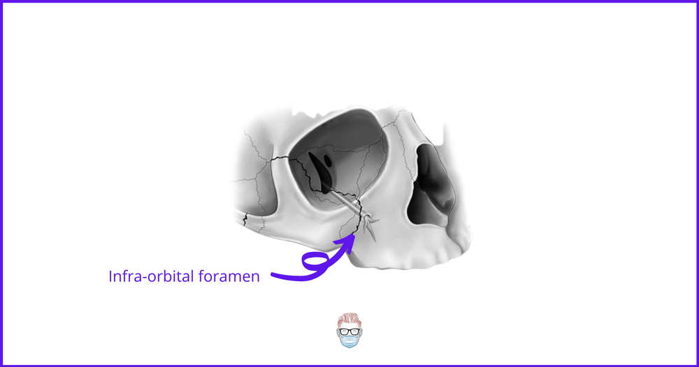 Zygomaticomaxillary complex (ZMC) fractures