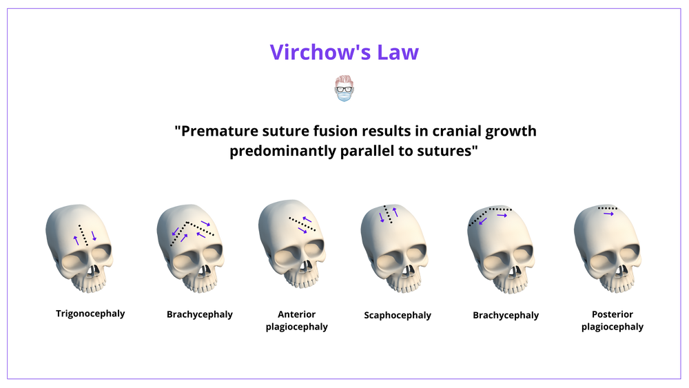 Craniosynostosis: Anatomy, Classification, & Investigations