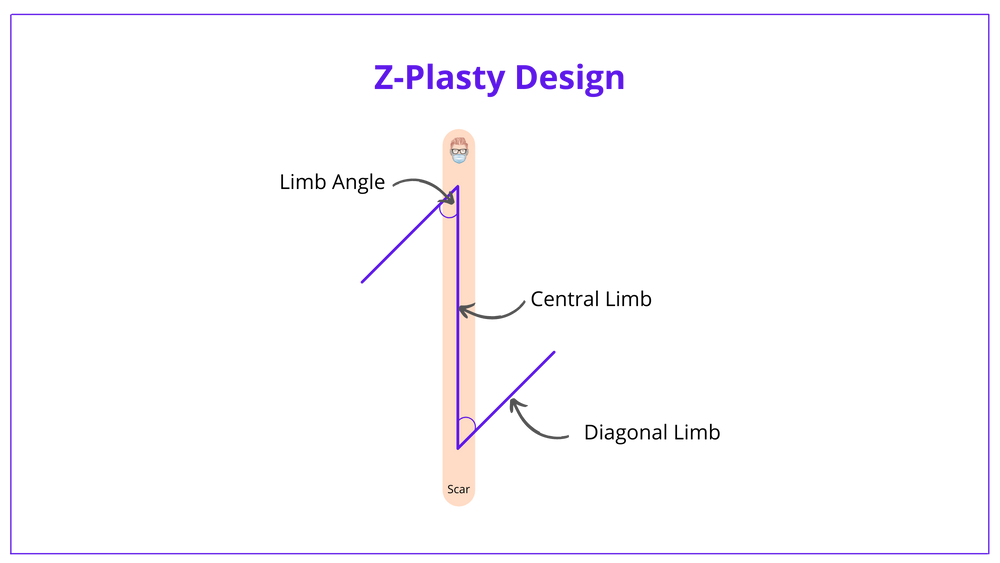 Z-Plasty: Designs, Indications, Variations and Complications