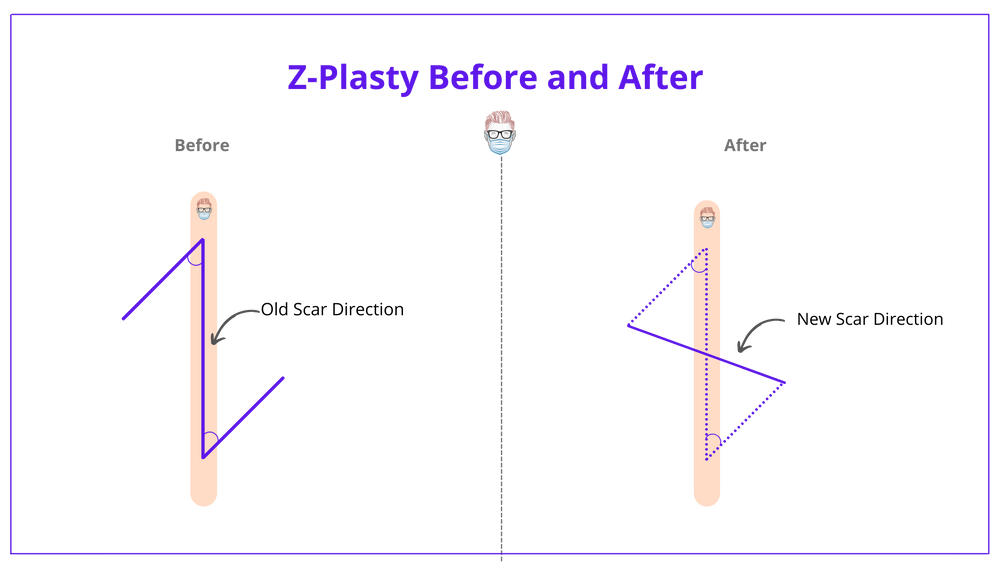 Z-Plasty: Designs, Indications, Variations and Complications
