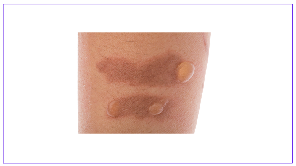 Burn Depth - Classification, Assessment, Characteristics.