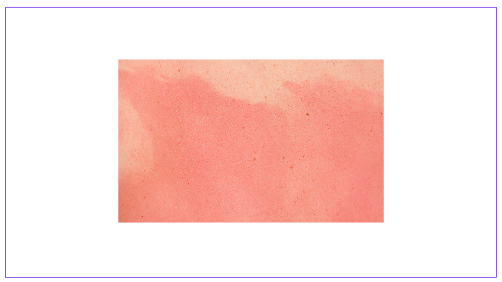 Burn Depth - Classification, Assessment, Characteristics.