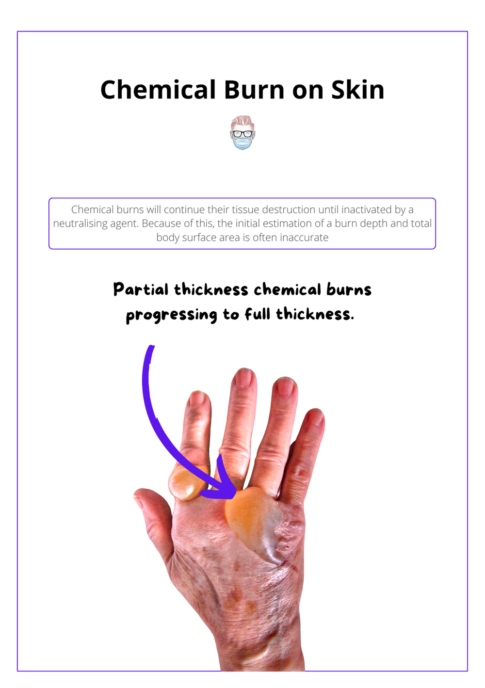 Chemical Burns · Types, Complications, Management