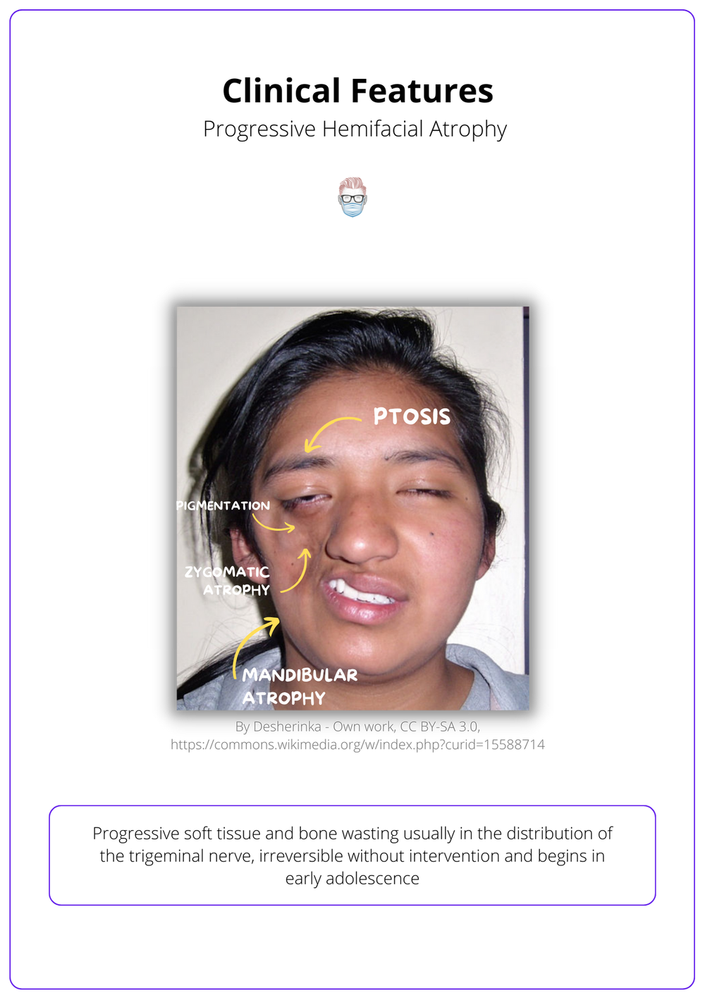 Progressive Hemifacial Atrophy: Parry Romberg Disease