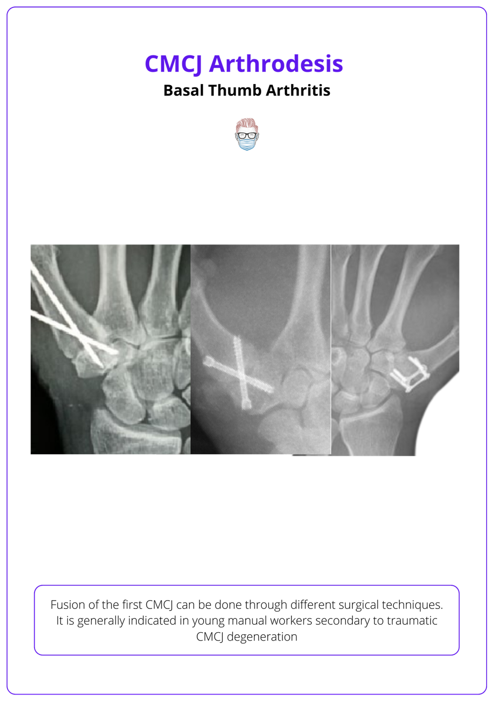Basal Thumb Osteoarthritis: Anatomy, Pathophysiology, Diagnosis, Treatment