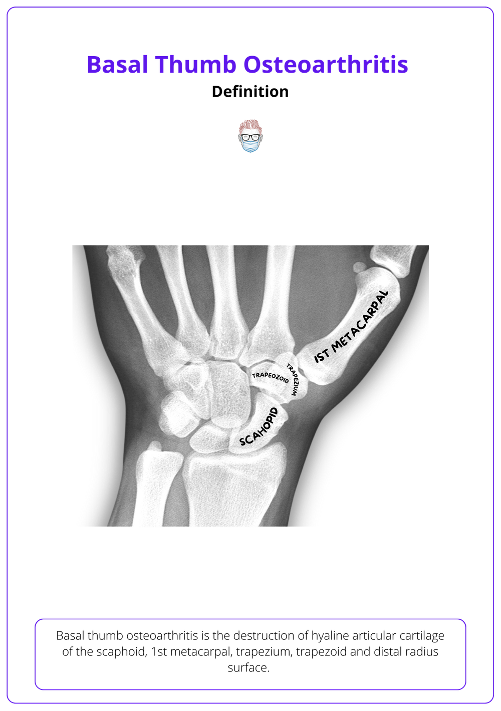 Basal Thumb Osteoarthritis: Anatomy, Pathophysiology, Diagnosis, Treatment
