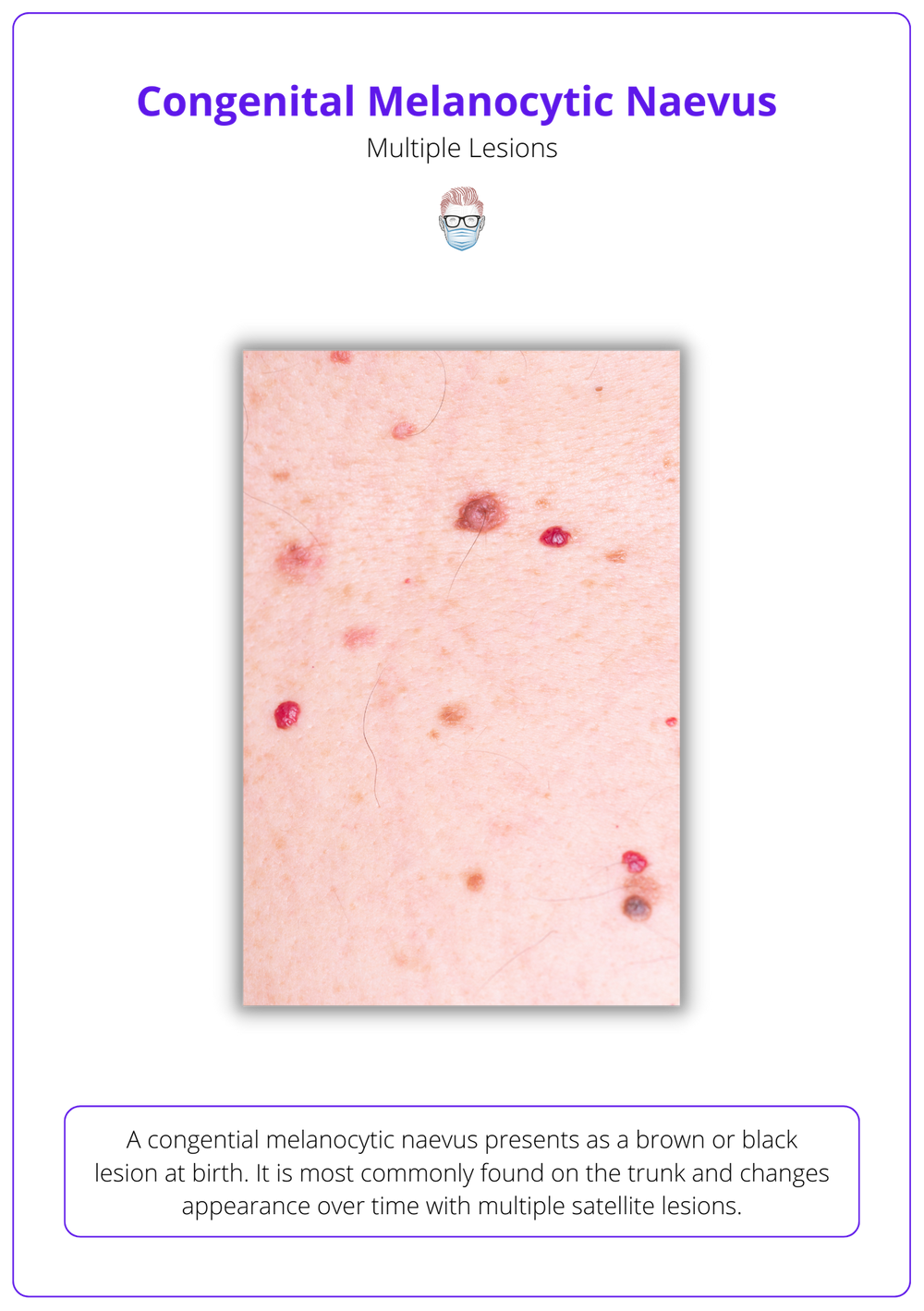 Congenital Melanocytic Naevus: Features & Management