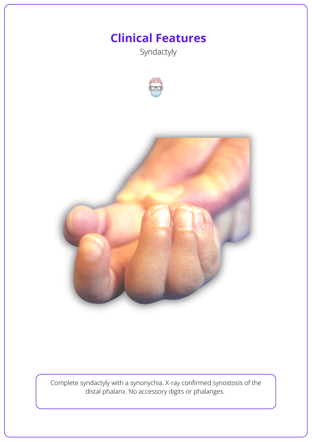 Syndactyly: Causes, Diagnosis, & Treatment