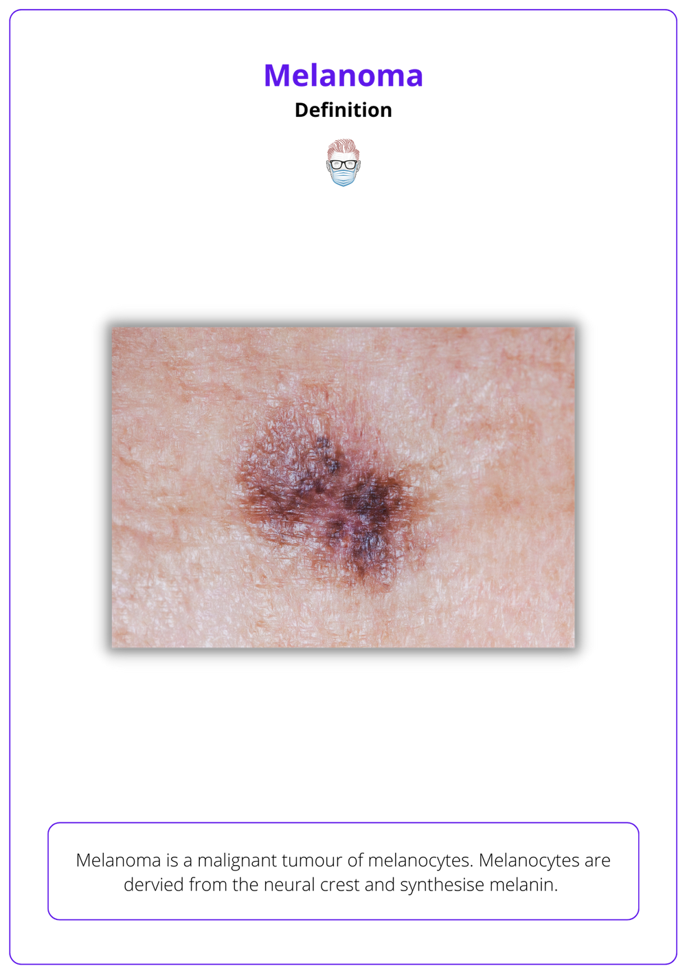 Melanoma Diagnosis Features Sentinel Node And Staging