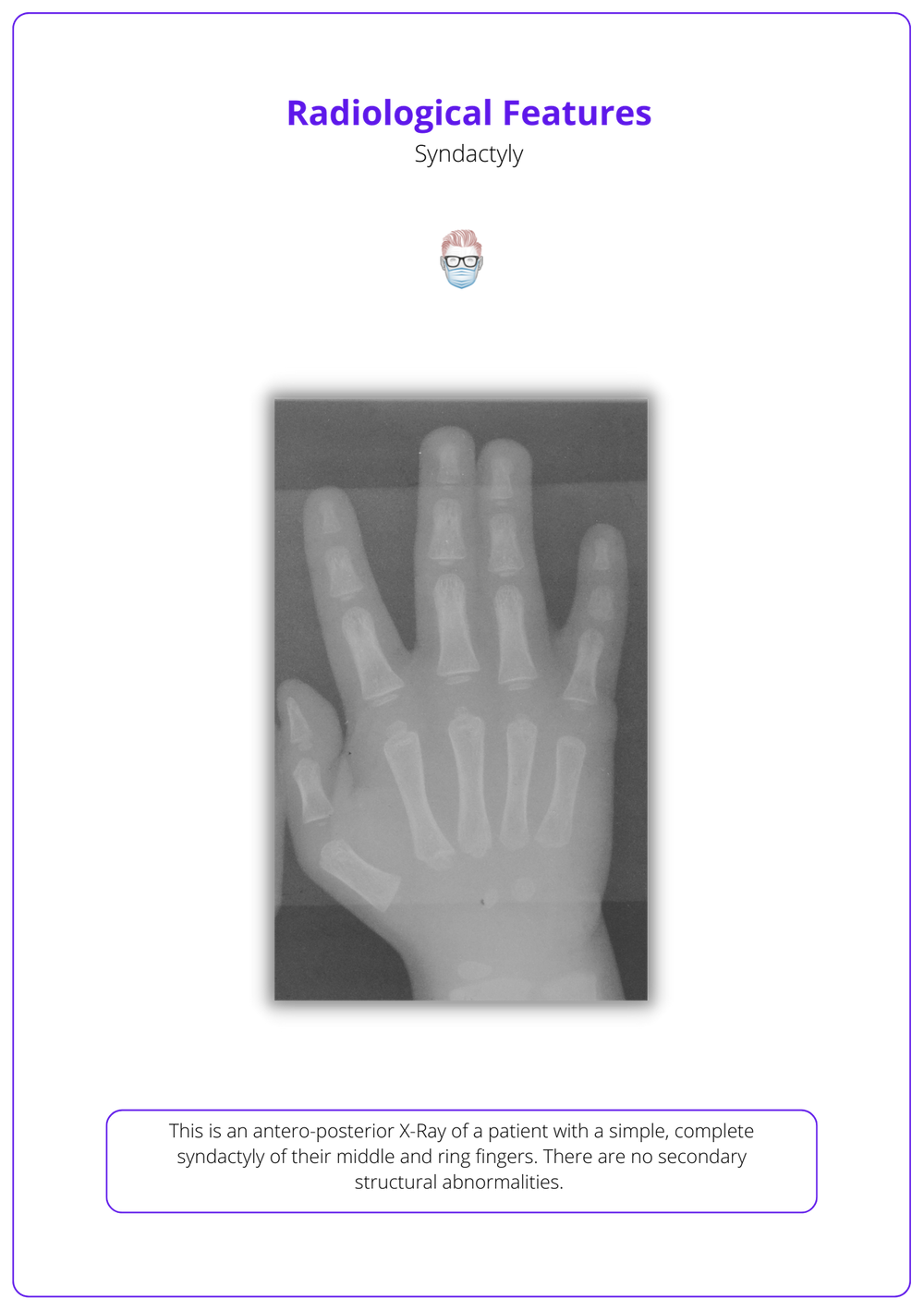 Syndactyly: Causes, Diagnosis, & Treatment