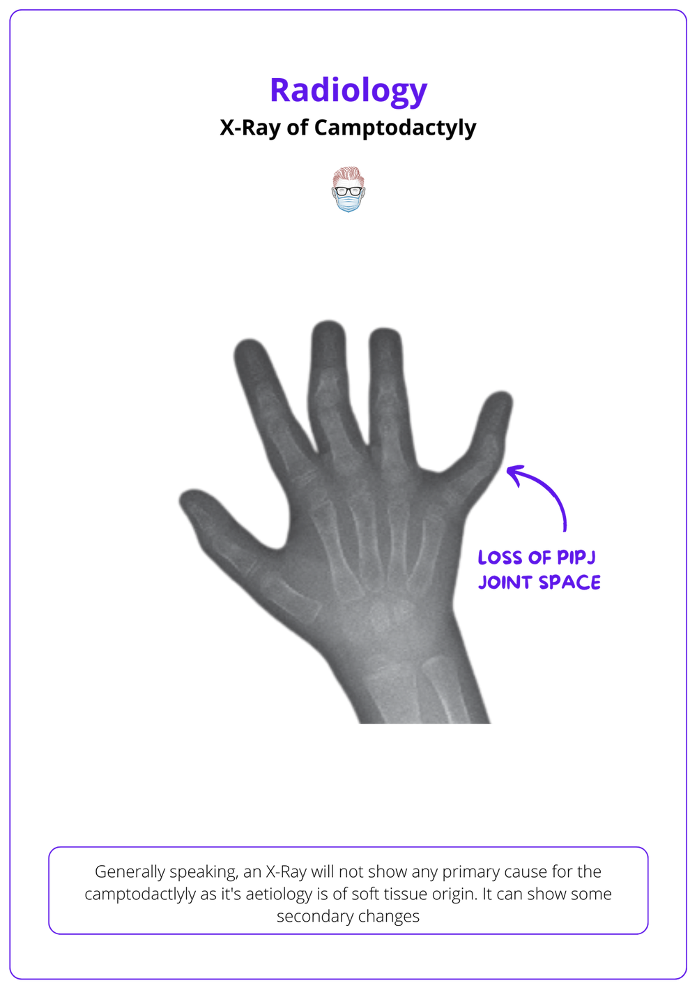 Camptodactyly: Features, Classification, & Management