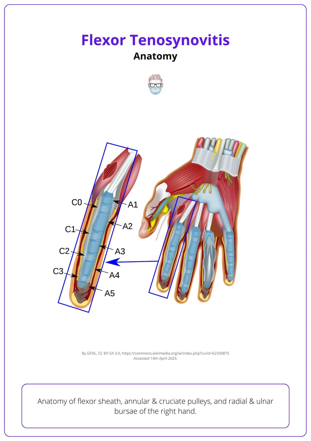 Pyogenic Flexor Tenosynovitis: Anatomy, Clinical View, & Treatment
