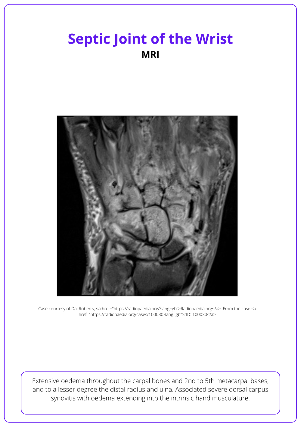 Septic Arthritis of the Hand: Causes, Diagnosis, & Treatment