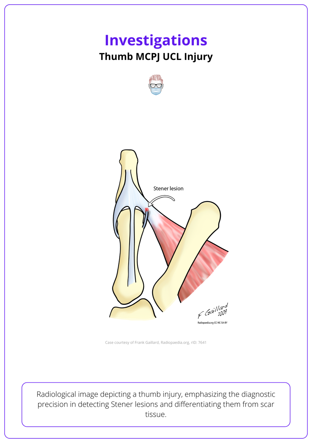 Thumb MCPJ UCL Injury: Thumb Anatomy, Diagnosis & Management
