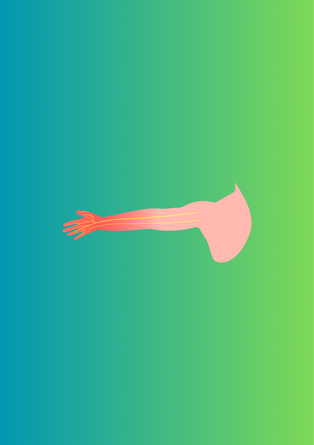 AIN Syndrome: Pathophysiology, Diagnosis, & Treatment