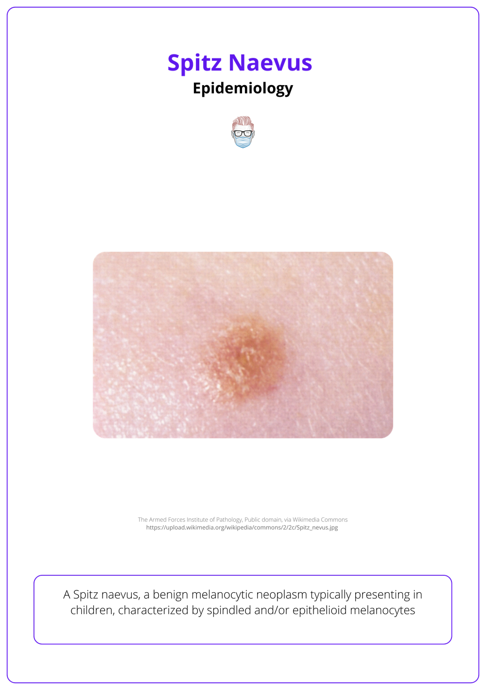 Spitz Naevus: Pathophysiology, Clinical Features, Management