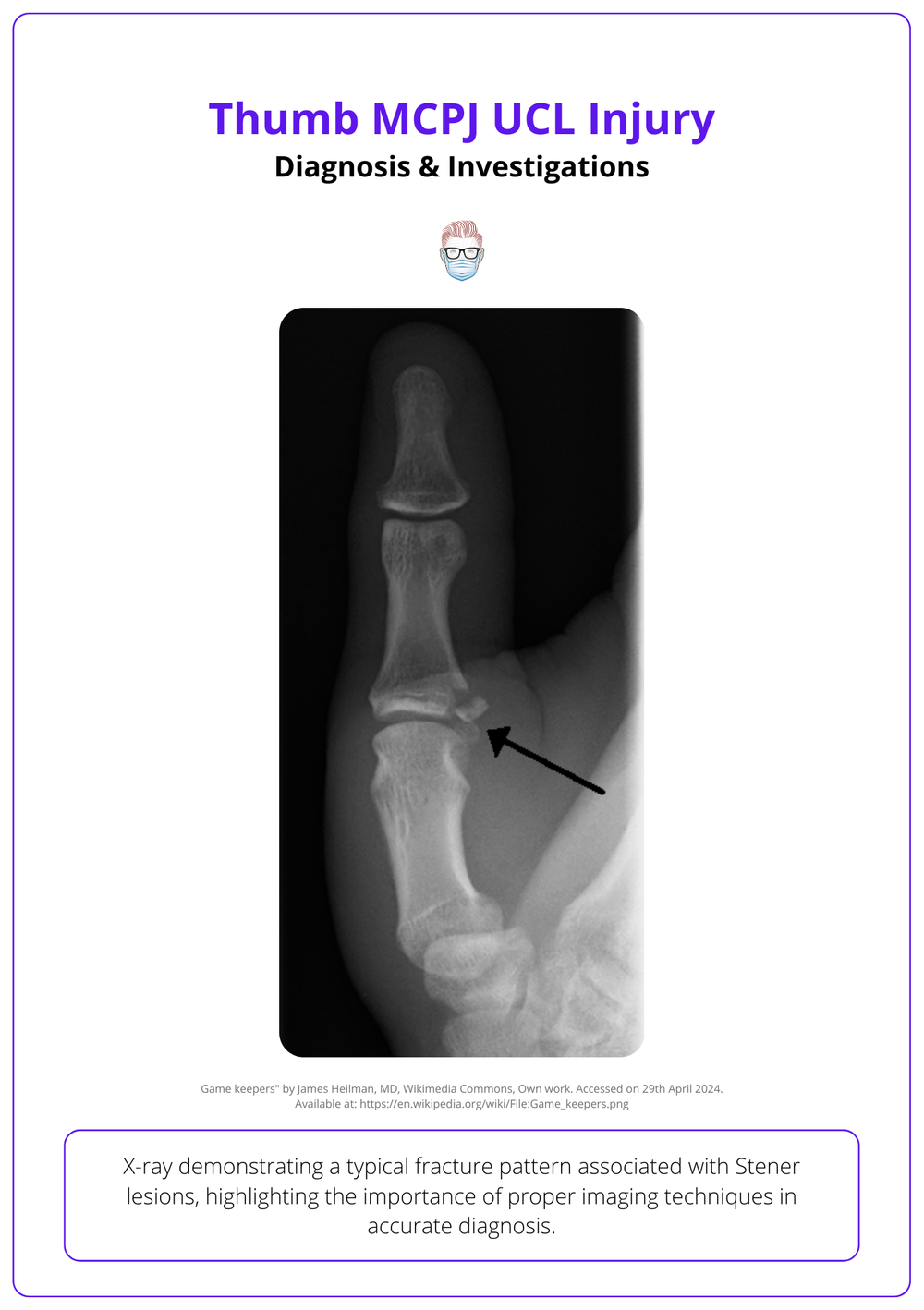 Thumb MCPJ UCL Injury: Thumb Anatomy, Diagnosis & Management