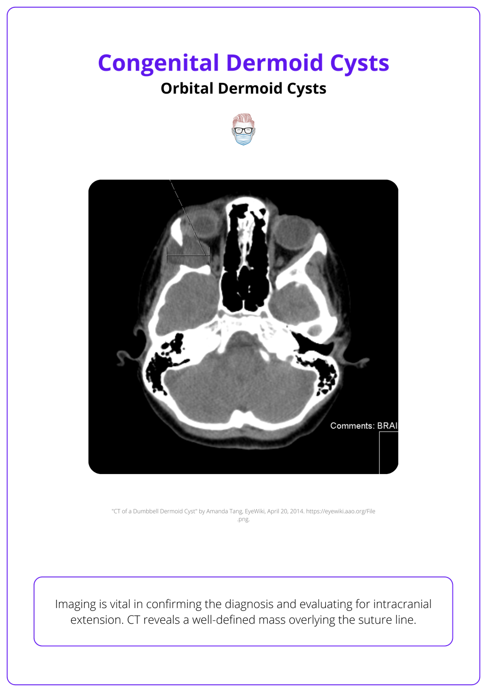 Congenital and Nasal Dermoid Cysts: Pathology, Presentation, & Treatment