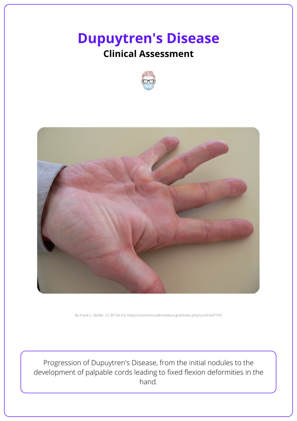 Dupuytren's Disease: Pathoanatomy, Clinical Assessment, & Management