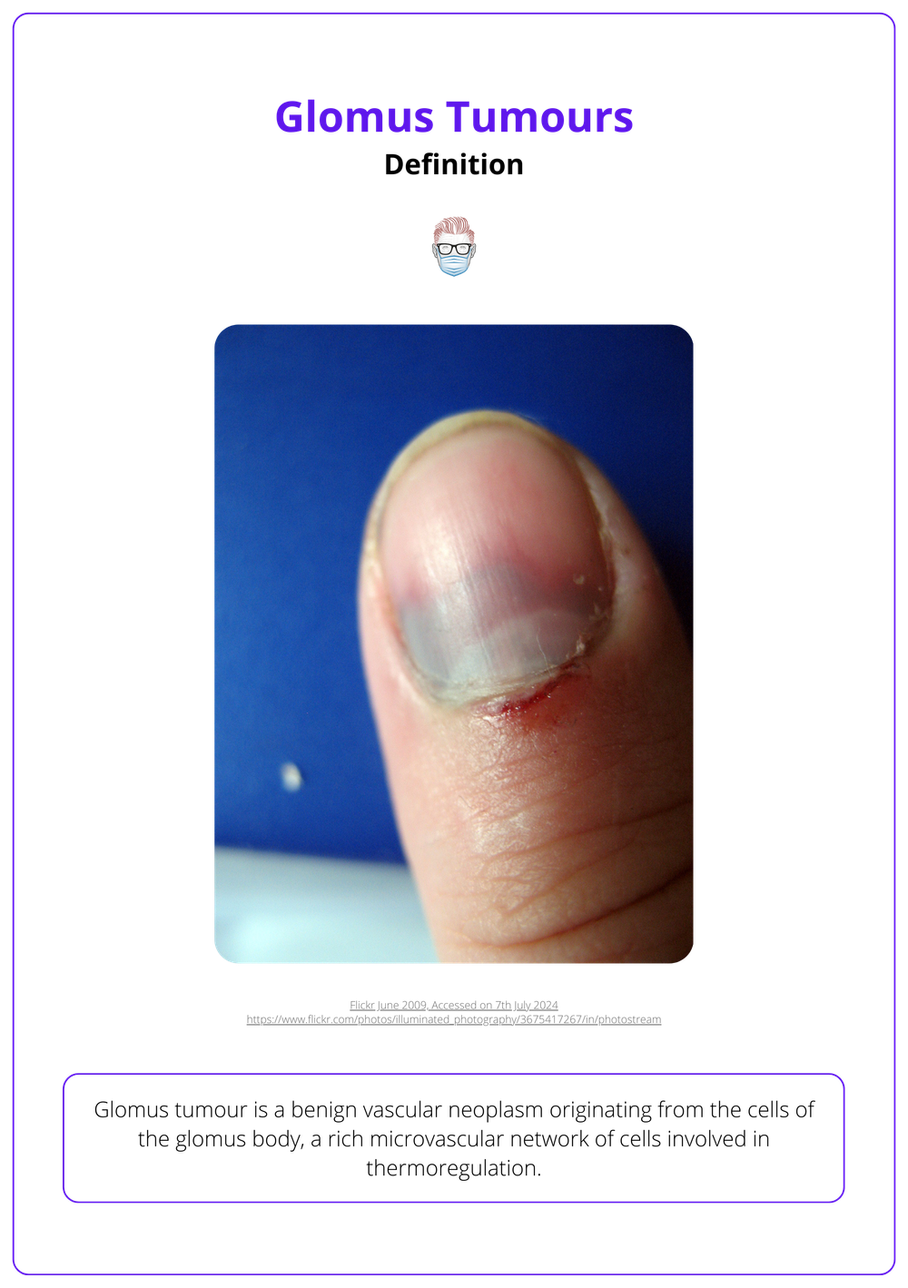 Glomus Tumours: Pathology, Diagnosis, & Management