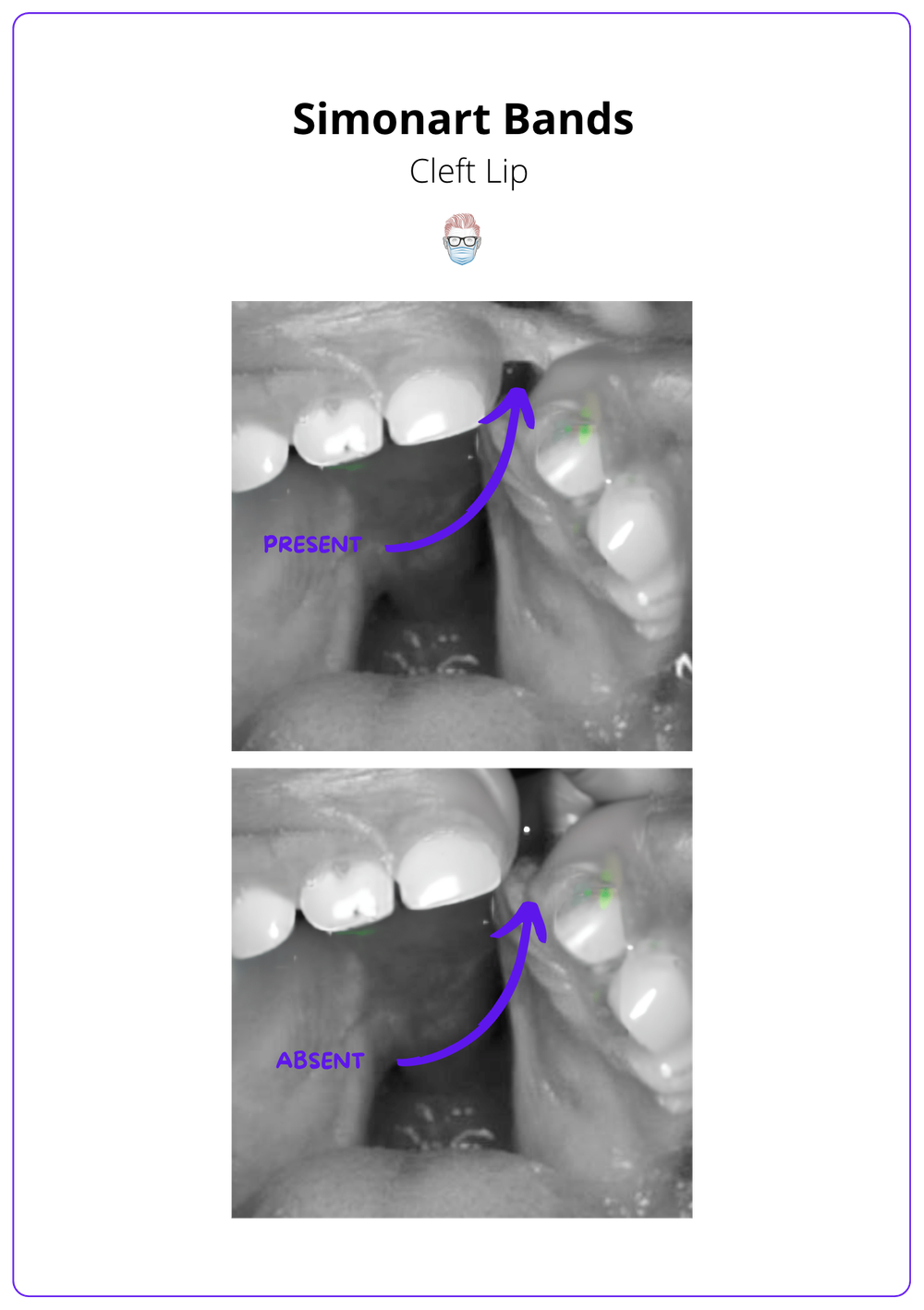 Cleft Lip: Classification, Clinical Features, & Surgical Repair