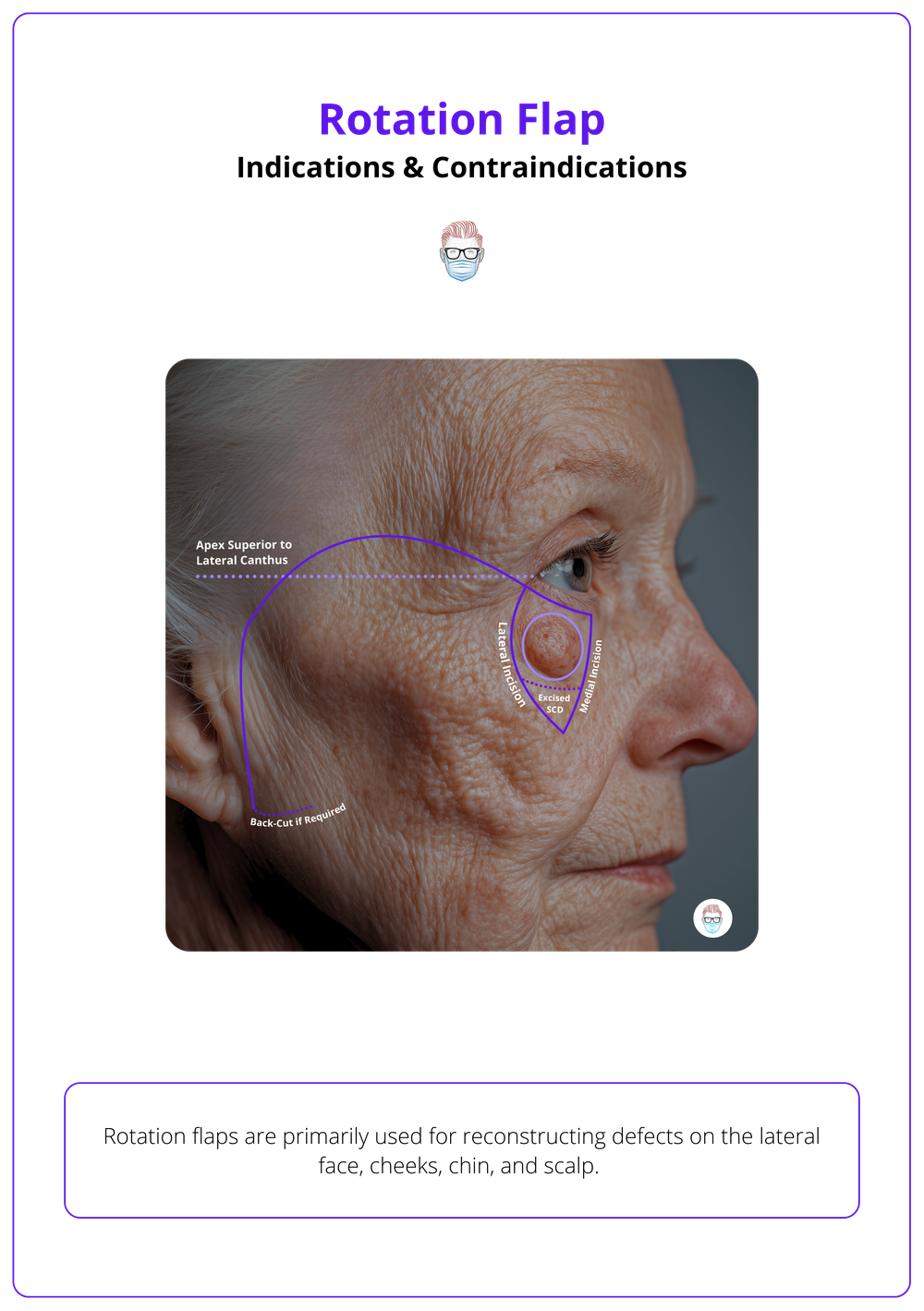 Rotation Flap: Design Principles, Complications, & Flap Modifications