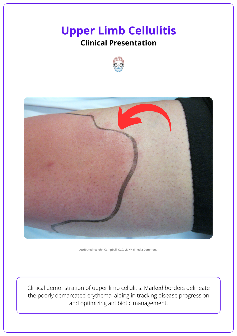 Upper Limb Cellulitis: Diagnosis, Management,& Complications