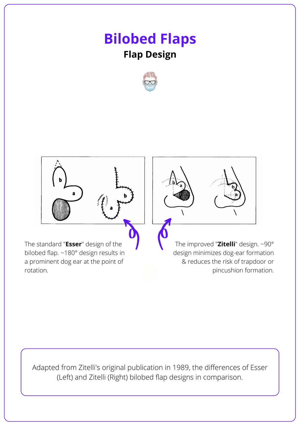 Bilobed Flaps: Indications, Flap Design, & Complications