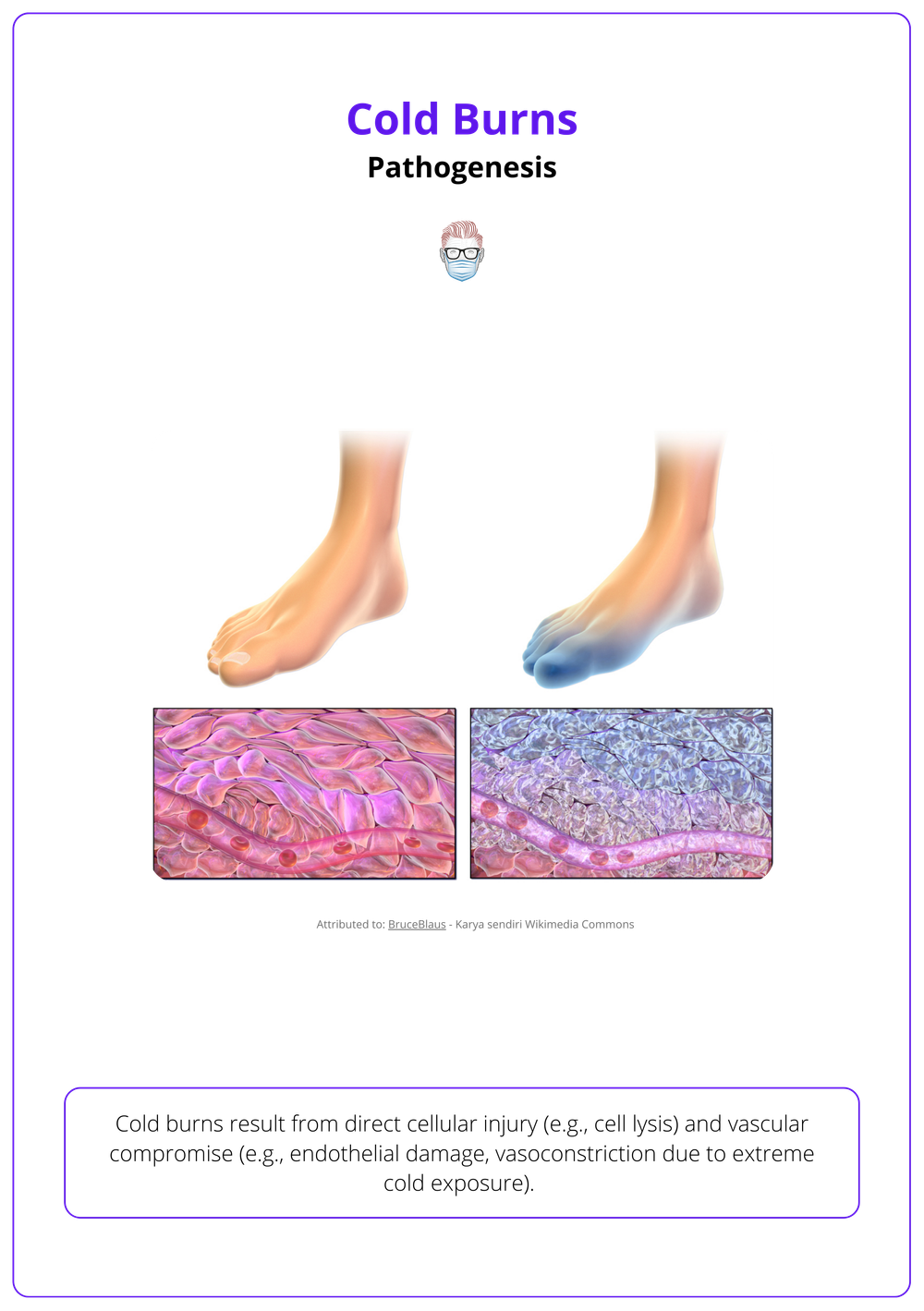 Cold Burns: Causes, Clinical Presentation, & Treatment