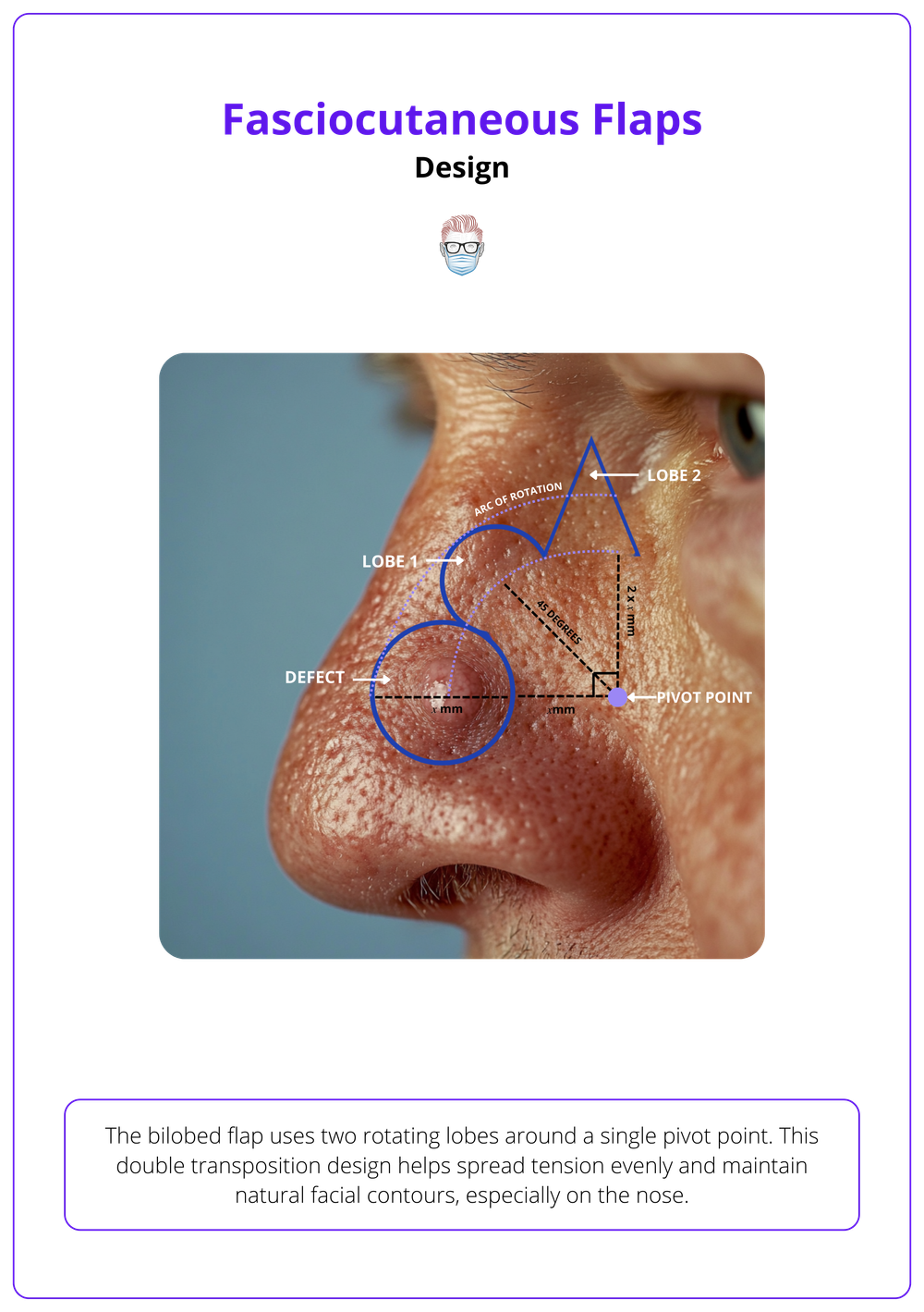 Bilobed Flaps: Indications, Flap Design, & Complications