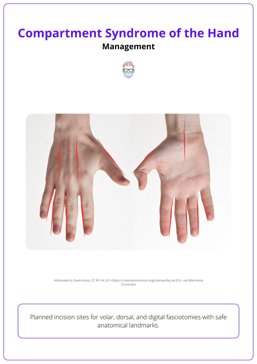 Compartment Syndrome of the Hand: Clinical Assessment, Investigations ...