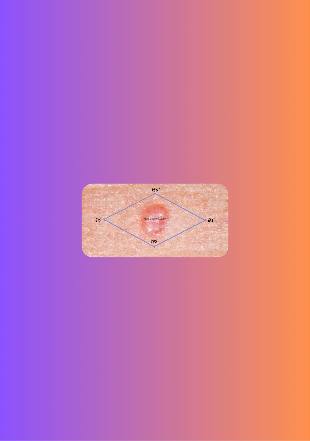 Rhomboid Flap: Design, Surgical Technique, & Complications