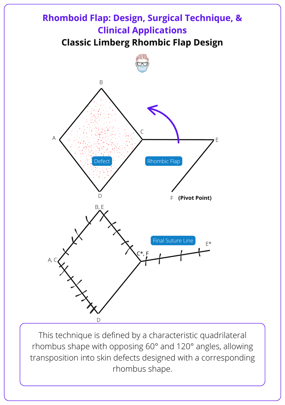 Rhomboid Flap: Design, Surgical Technique, & Complications