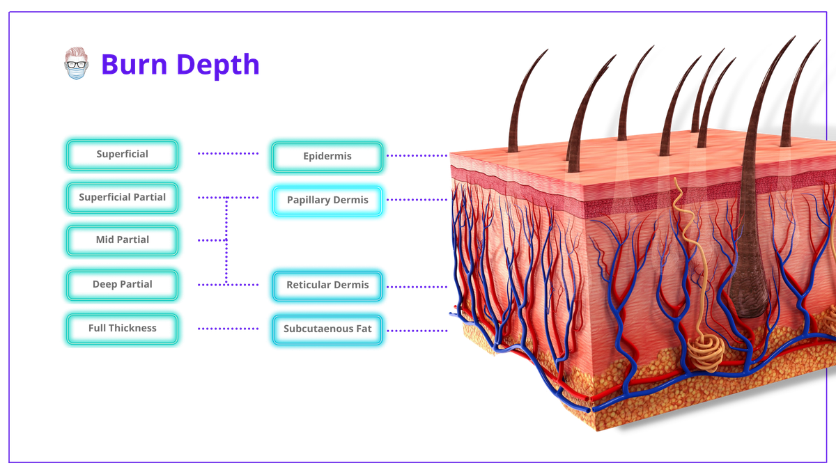Burn Depth - Classification, Assessment, Characteristics.
