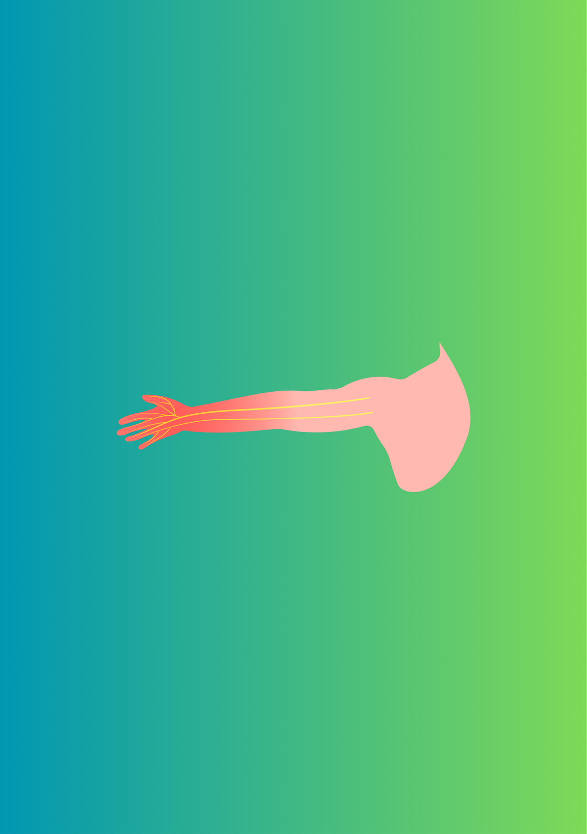 AIN Syndrome: Pathophysiology, Diagnosis, & Treatment