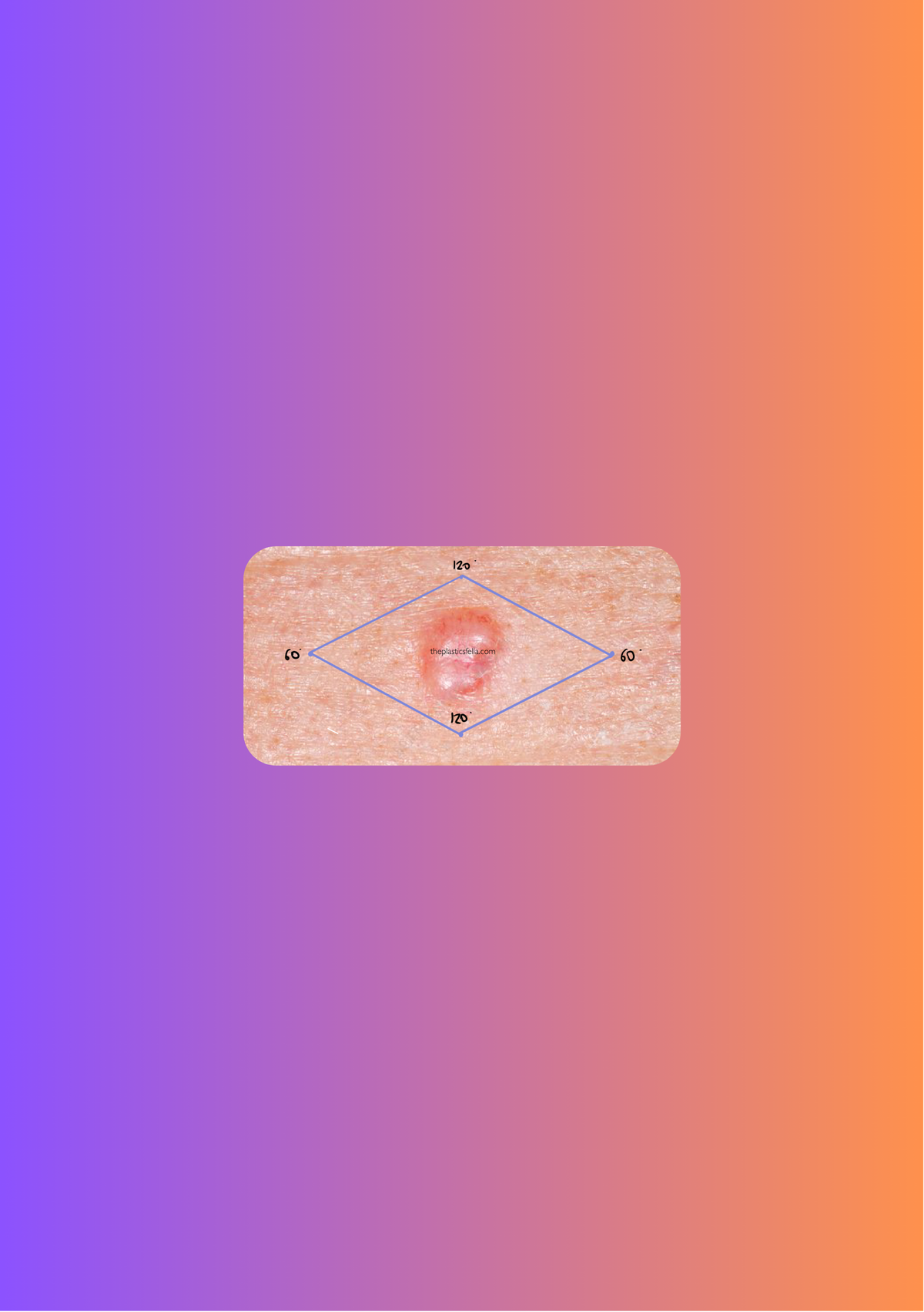 Rhomboid Flap: Design, Surgical Technique, & Complications