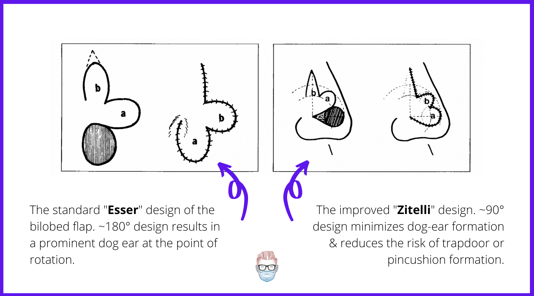 Bilobed Flaps Indications Design Pictures