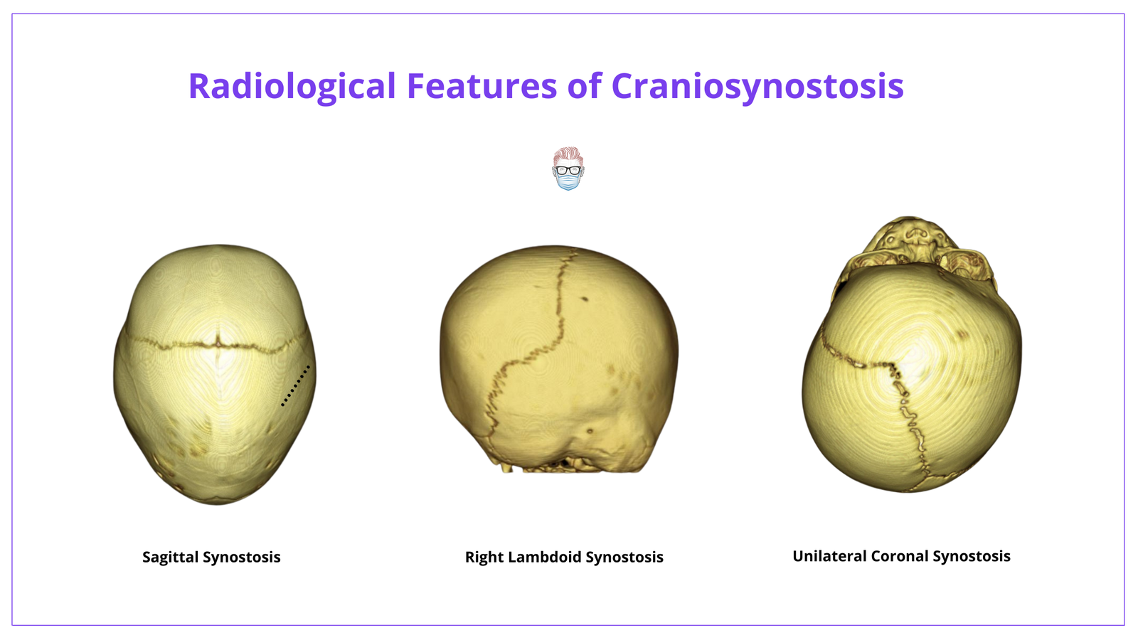 Craniosynostosis: Anatomy, Classification, & Investigations