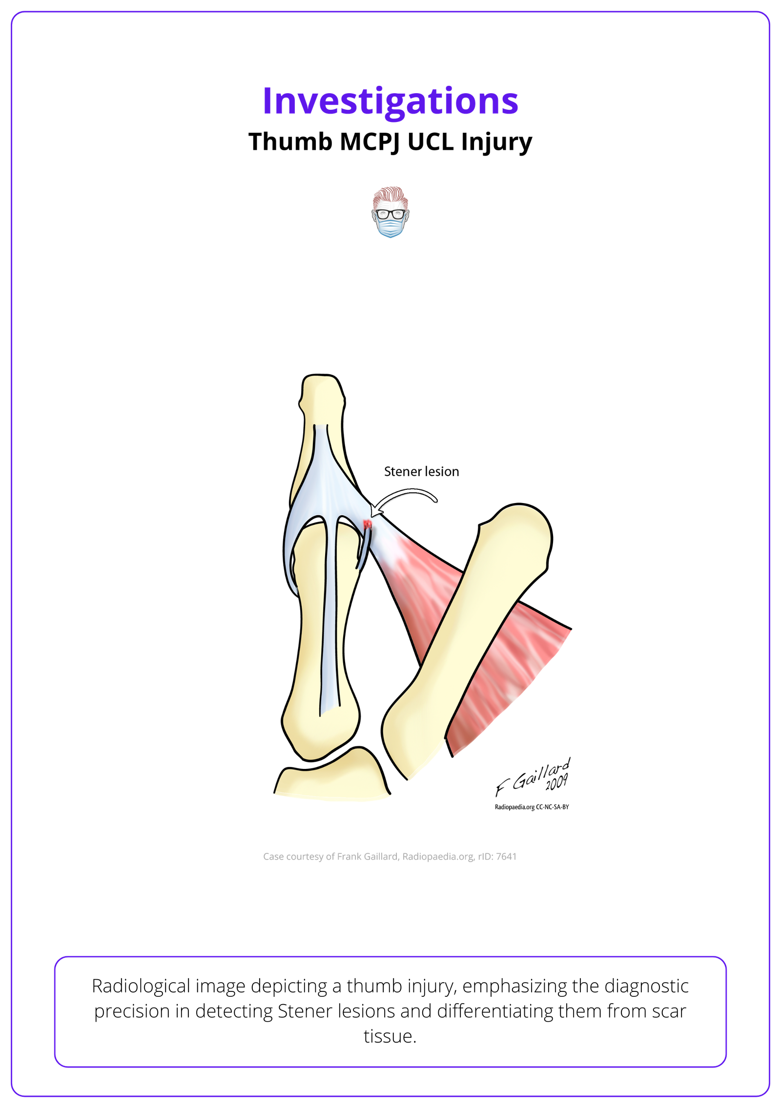 Thumb MCPJ UCL Injury: Thumb Anatomy, Diagnosis & Management