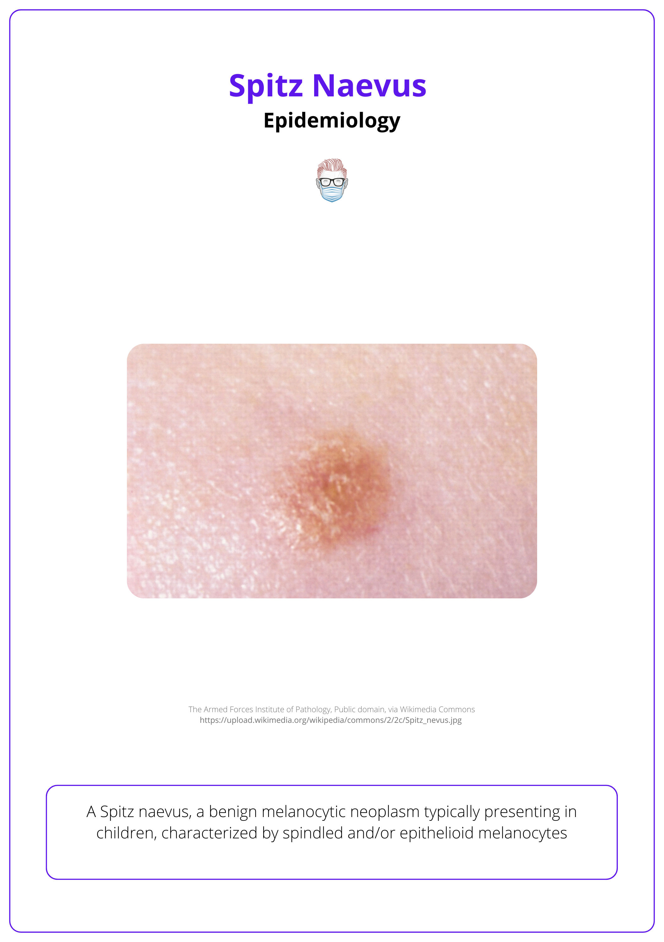 Spitz Naevus: Pathophysiology, Clinical Features, Management