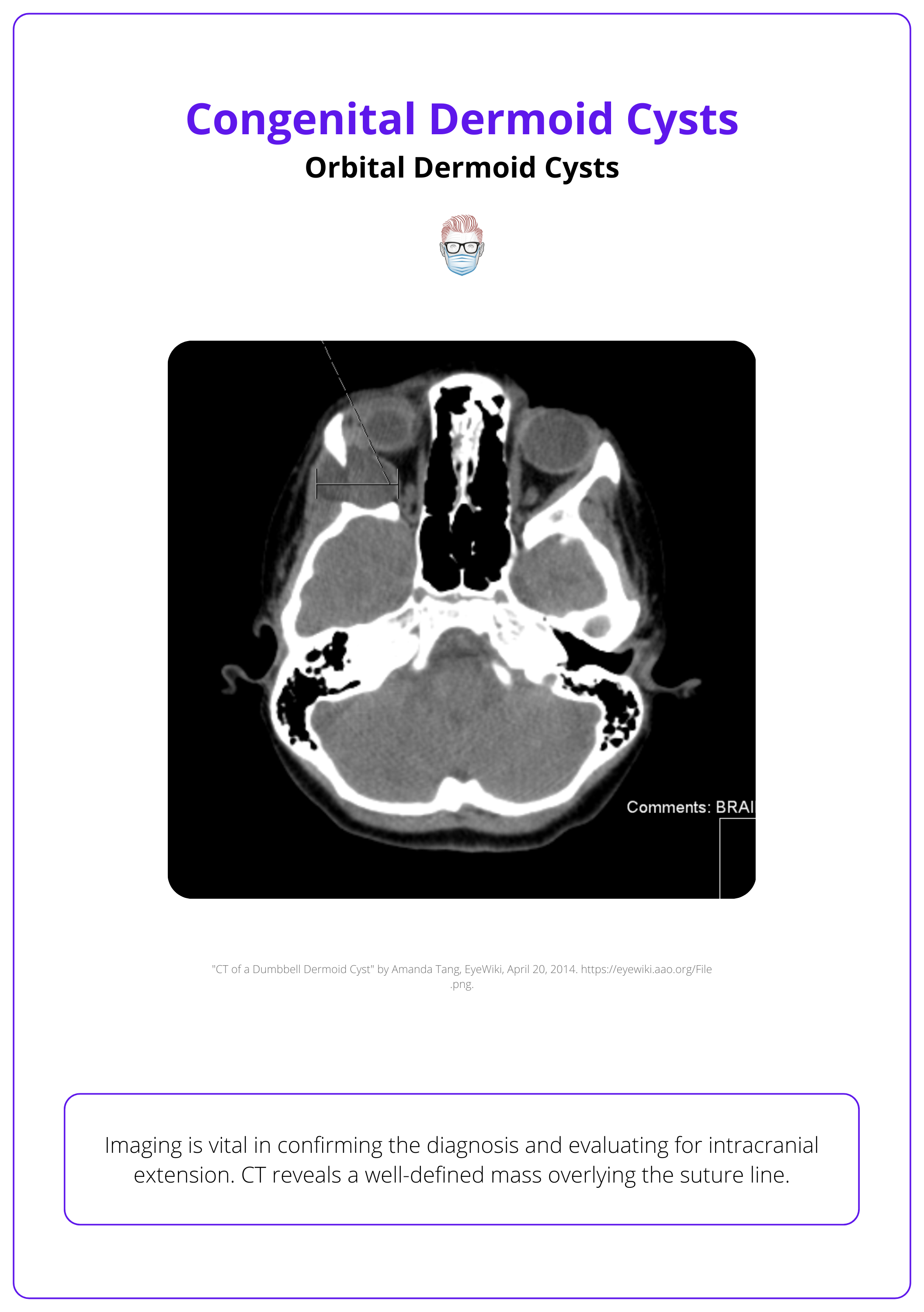Congenital and Nasal Dermoid Cysts: Pathology, Presentation, & Treatment