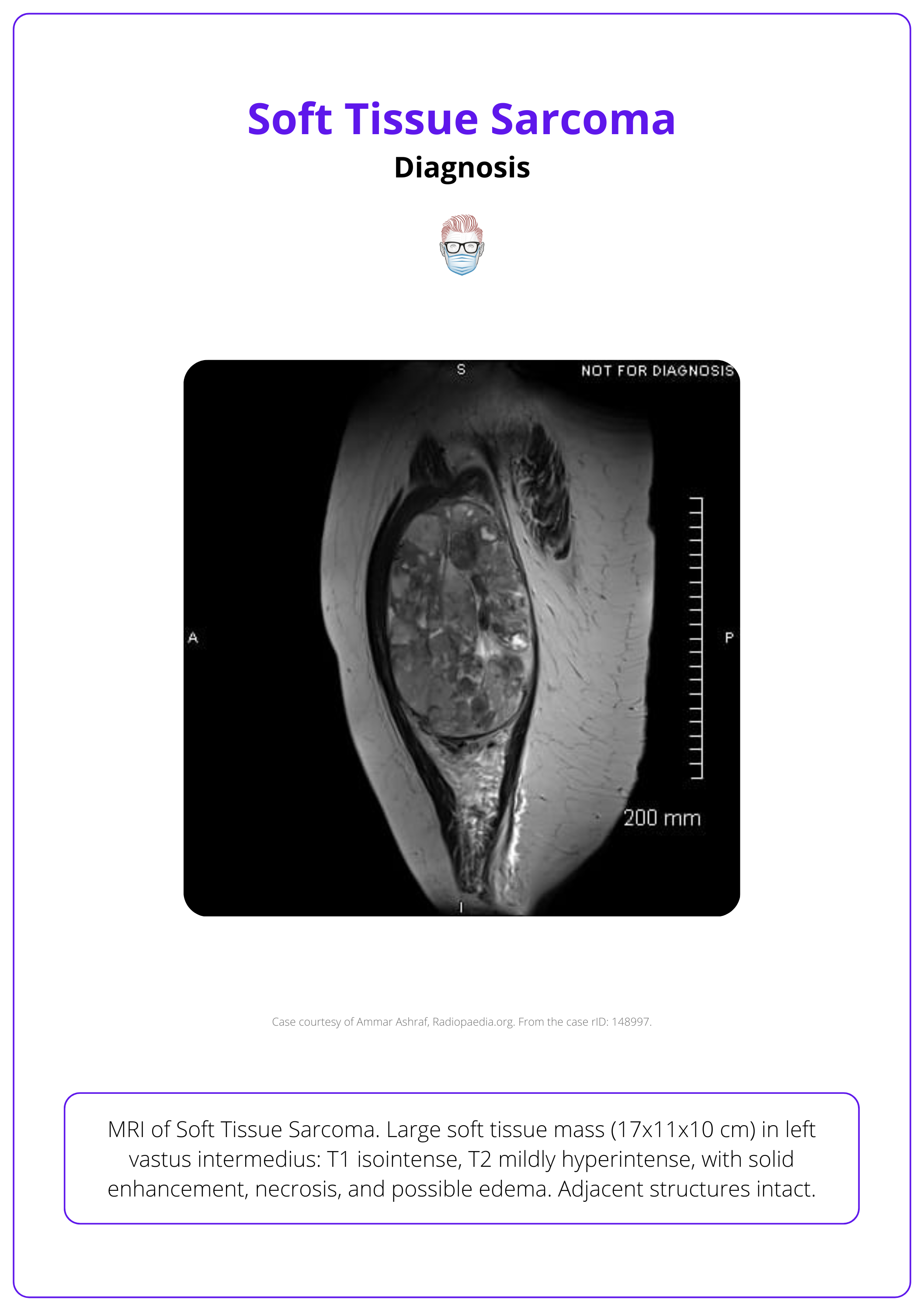 Soft Tissue Sarcoma: Classification, Diagnosis, & Management