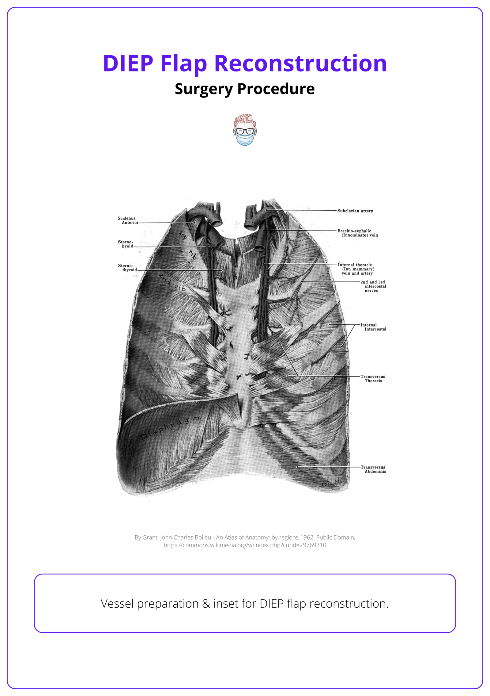 DIEP Flap Reconstruction: Anatomy, Key Surgical Steps, & Complications