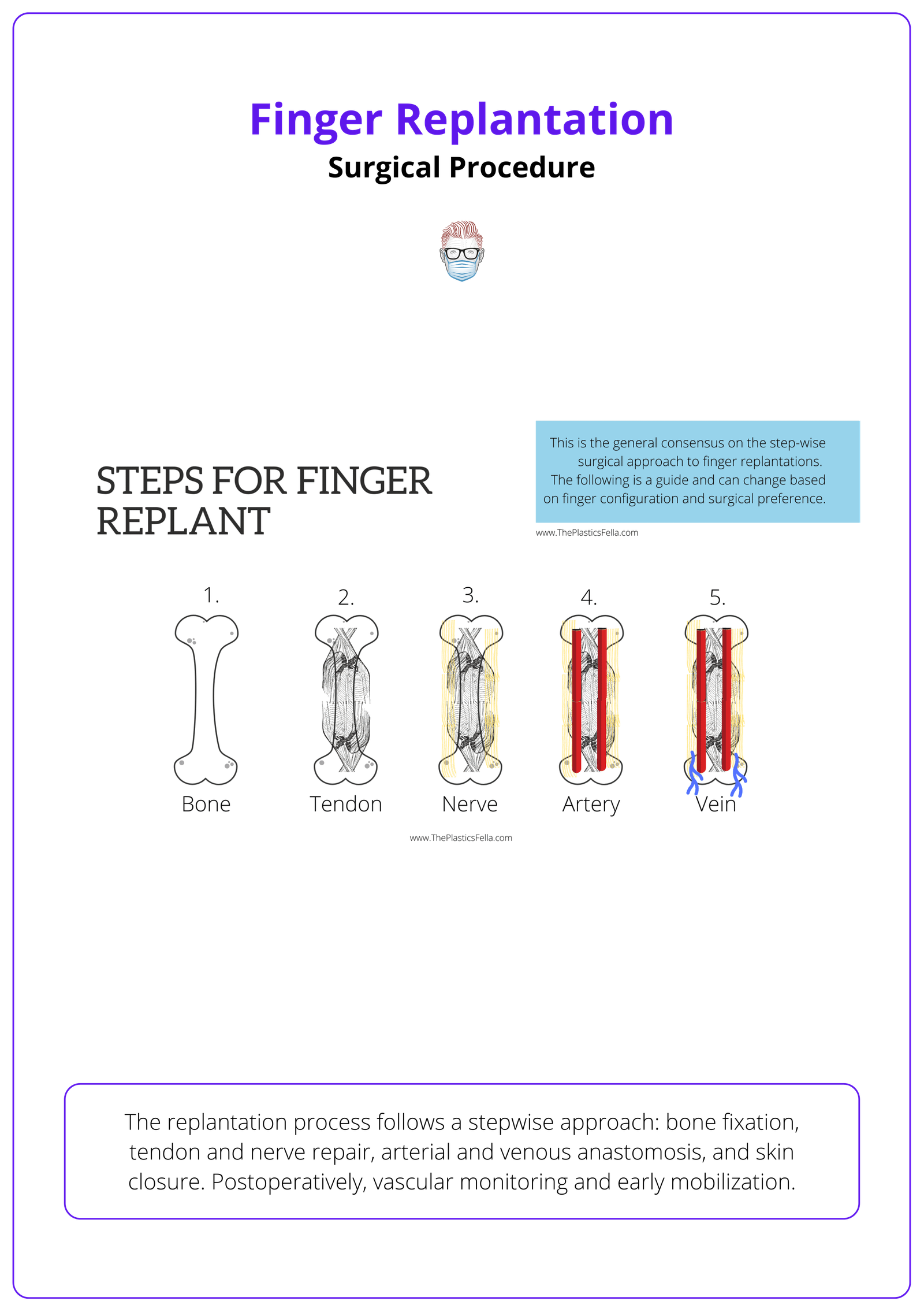 Finger Replantation: Indications, Surgical Technique, & Complications