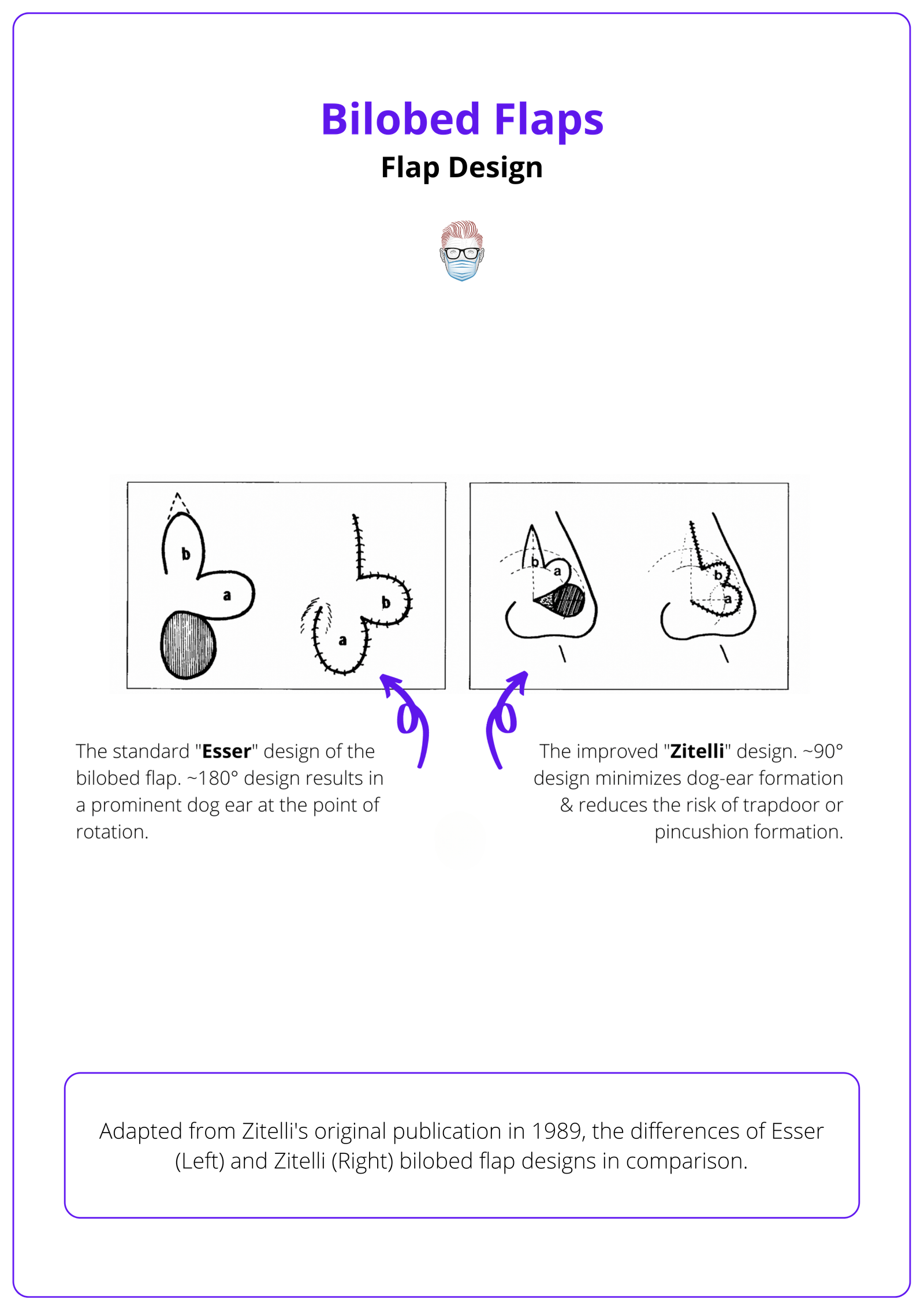 Bilobed Flaps: Indications, Flap Design, & Complications