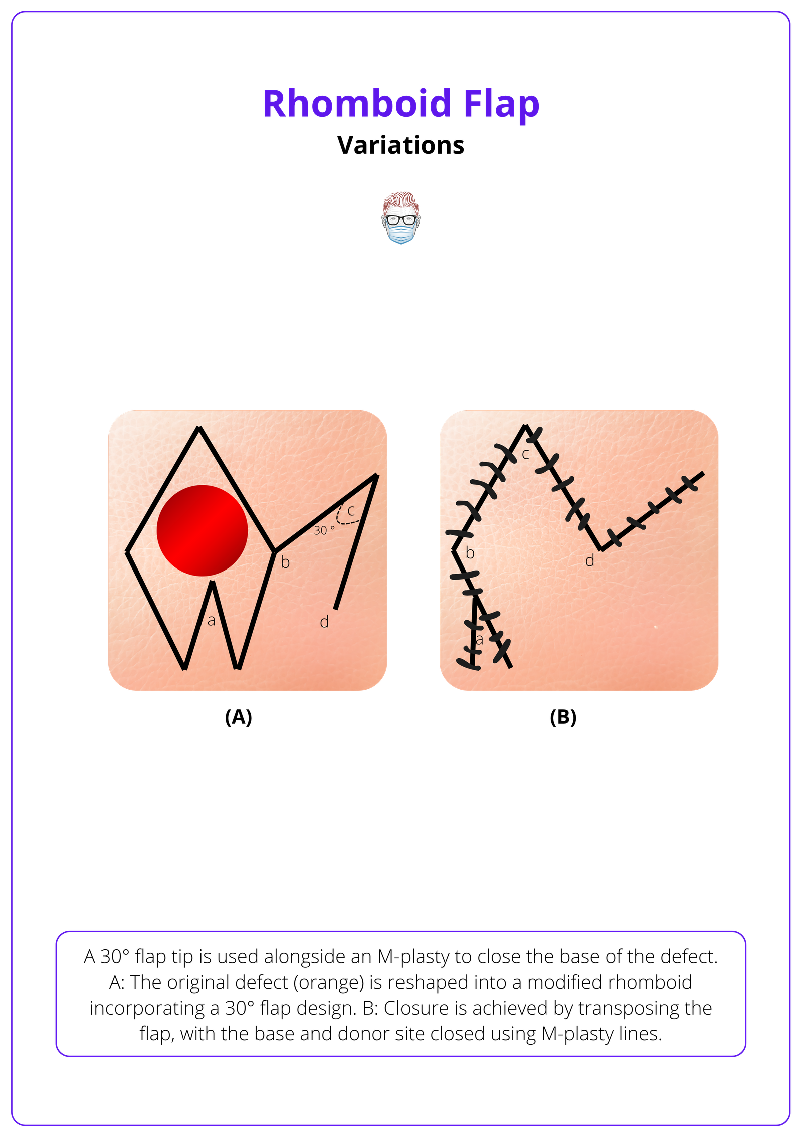 Rhomboid Flap: Design, Surgical Technique, & Complications