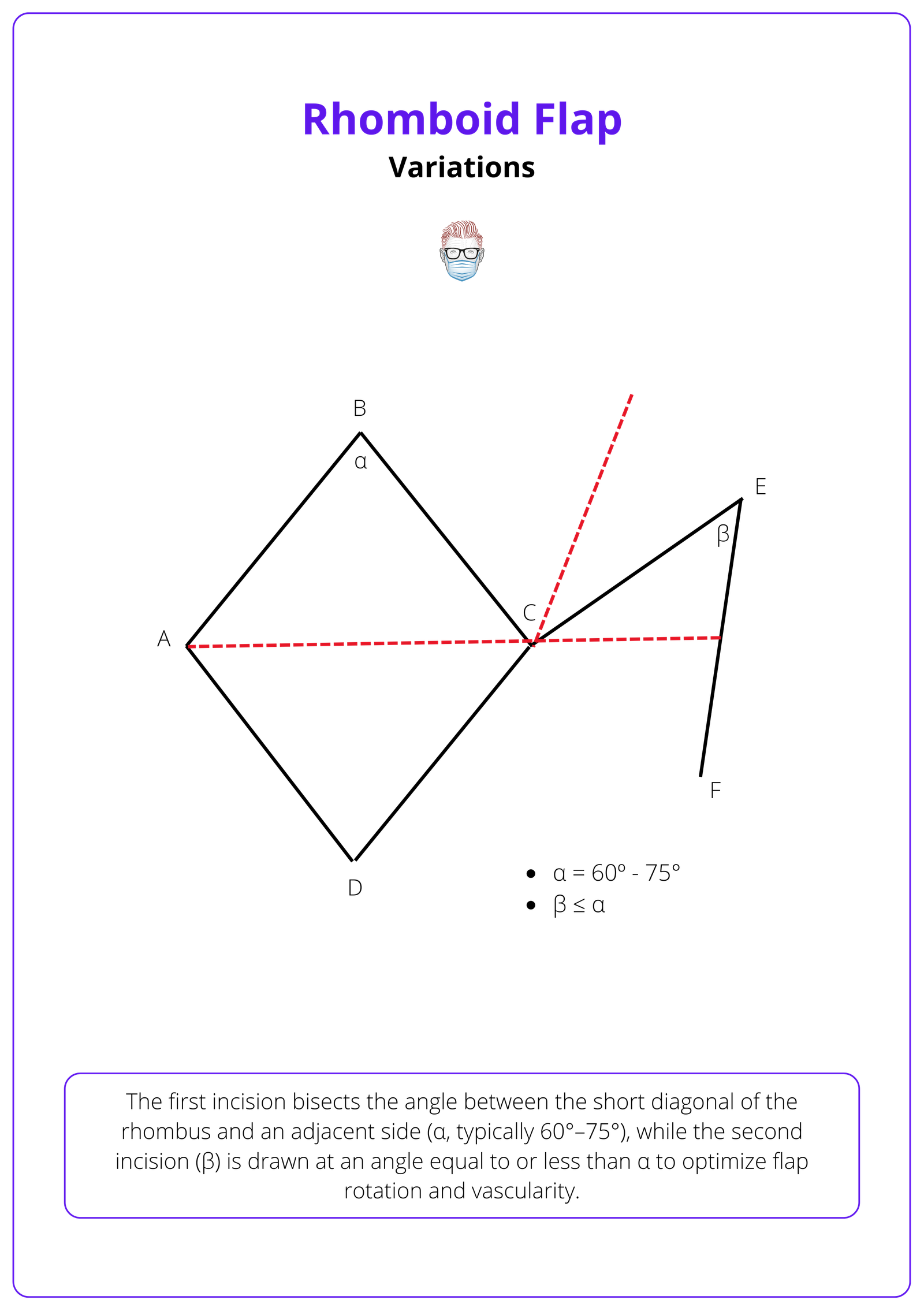 Rhomboid Flap: Design, Surgical Technique, & Complications