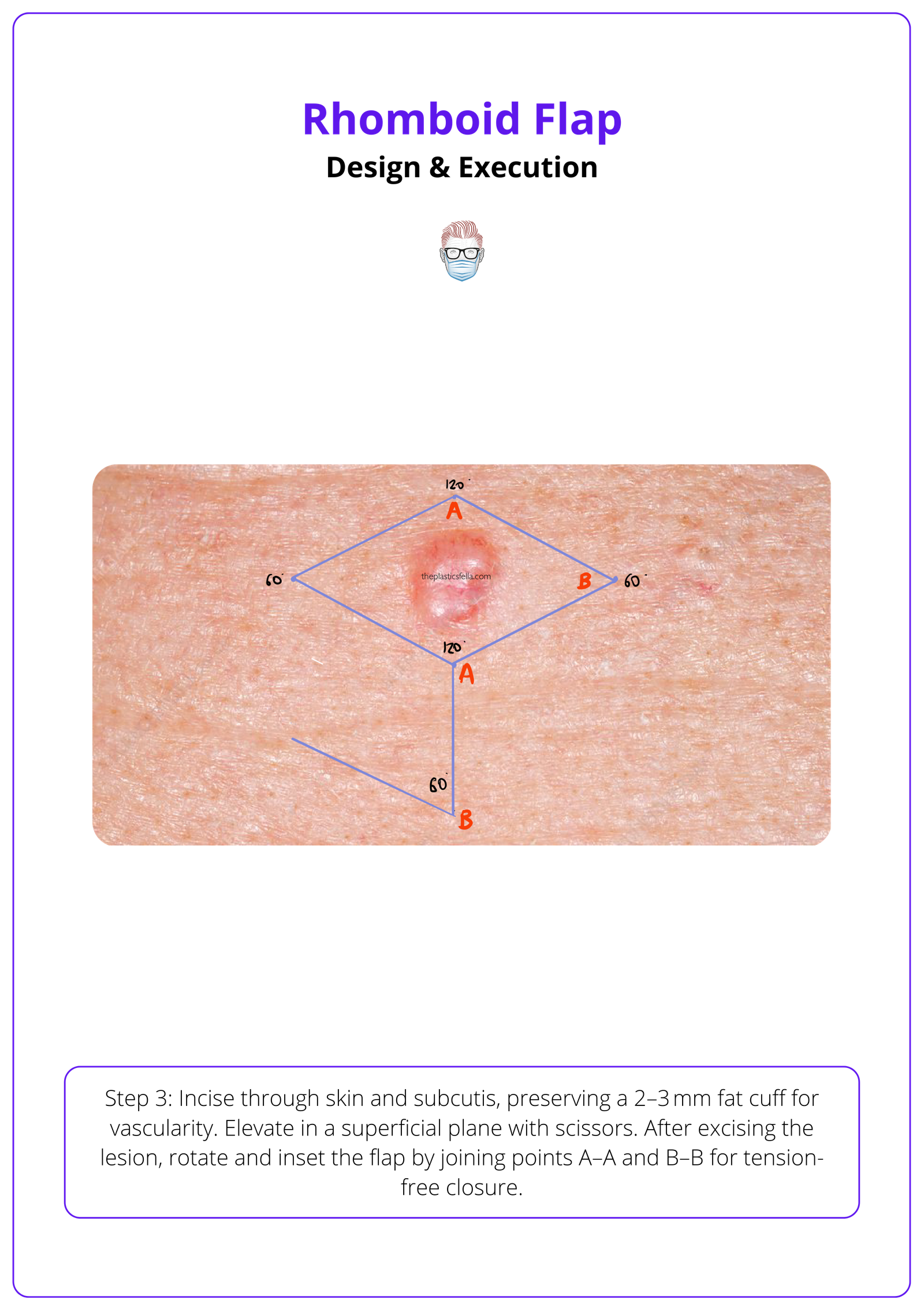 Rhomboid Flap: Design, Surgical Technique, & Complications